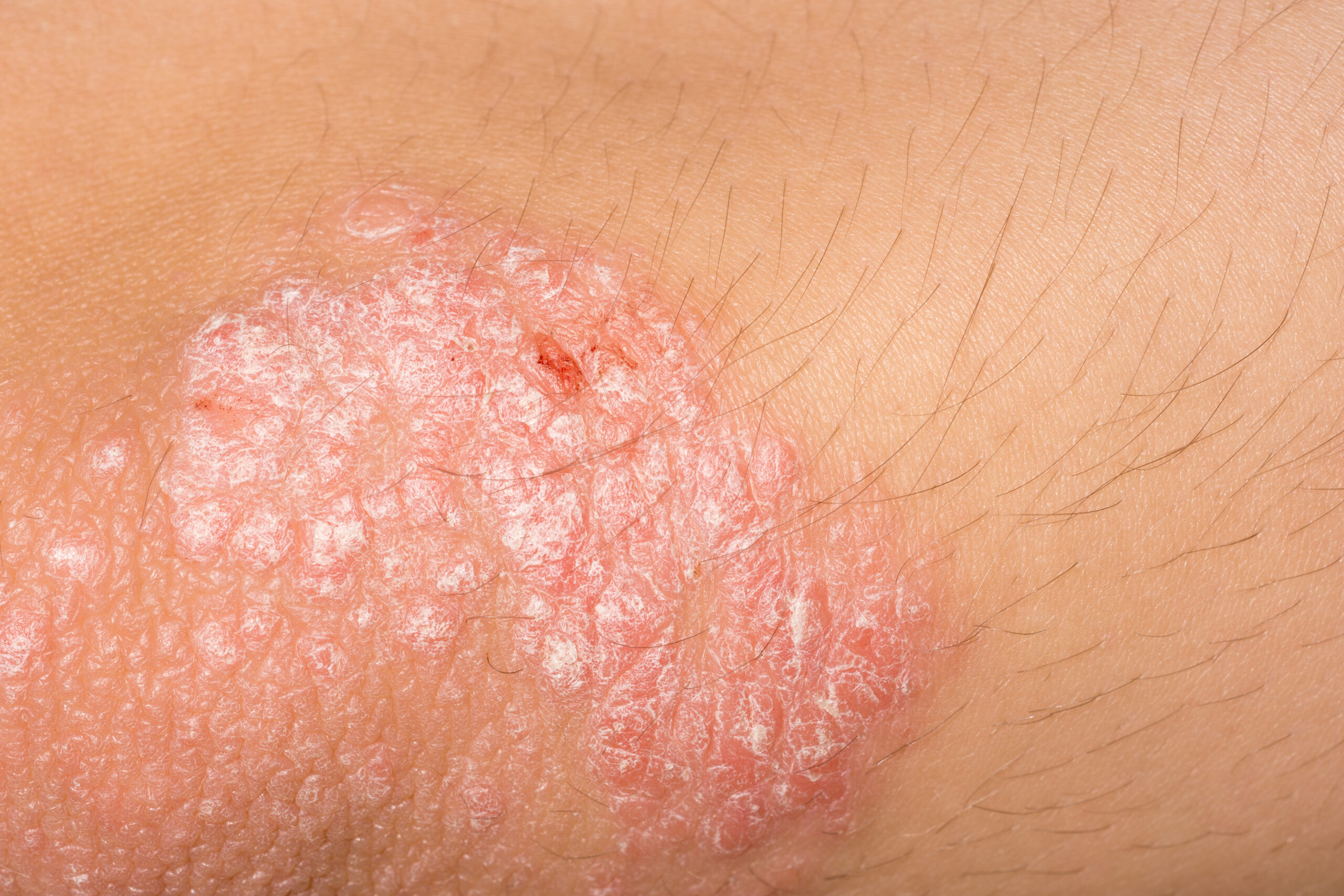 Psoriasis - Las Vegas Skin & Cancer Clinics