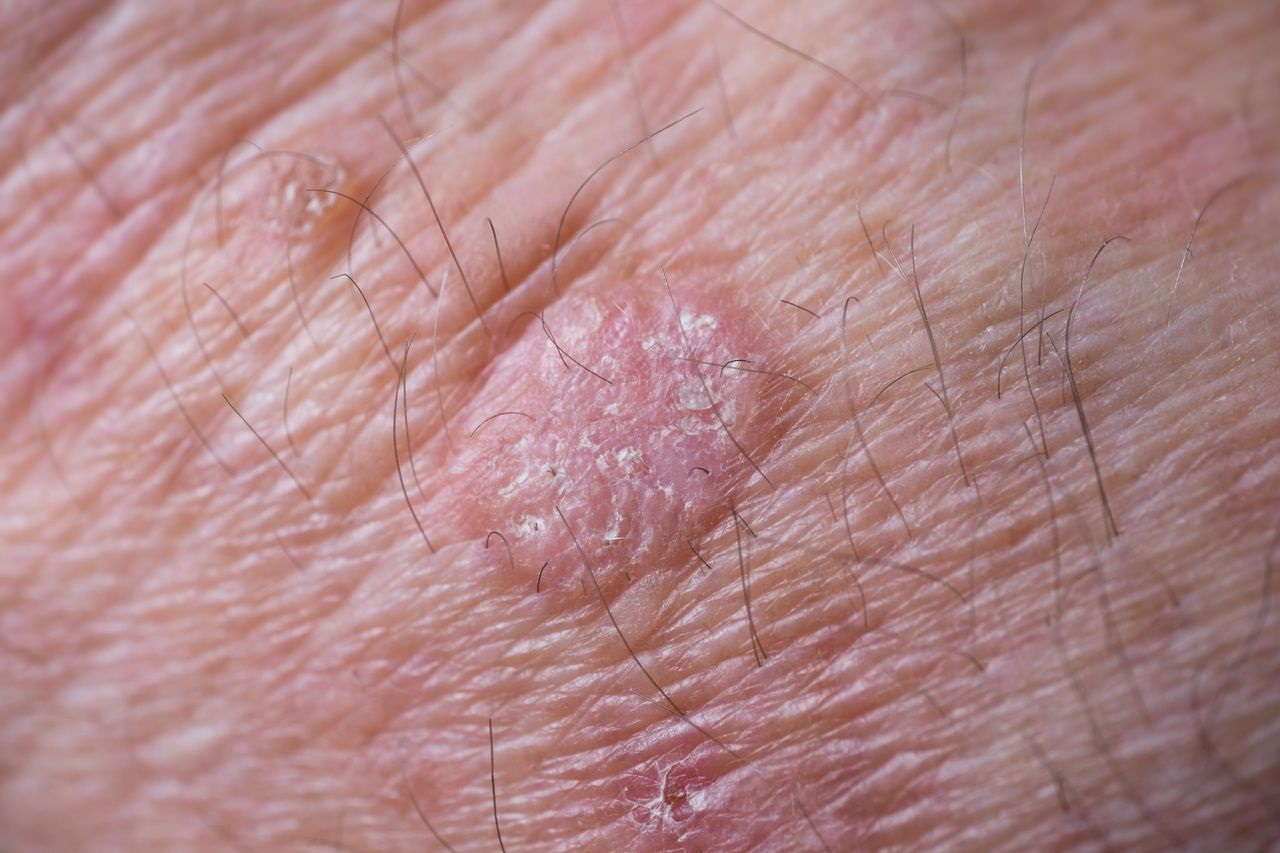 Actinic Keratoses - Las Vegas Skin & Cancer Clinics