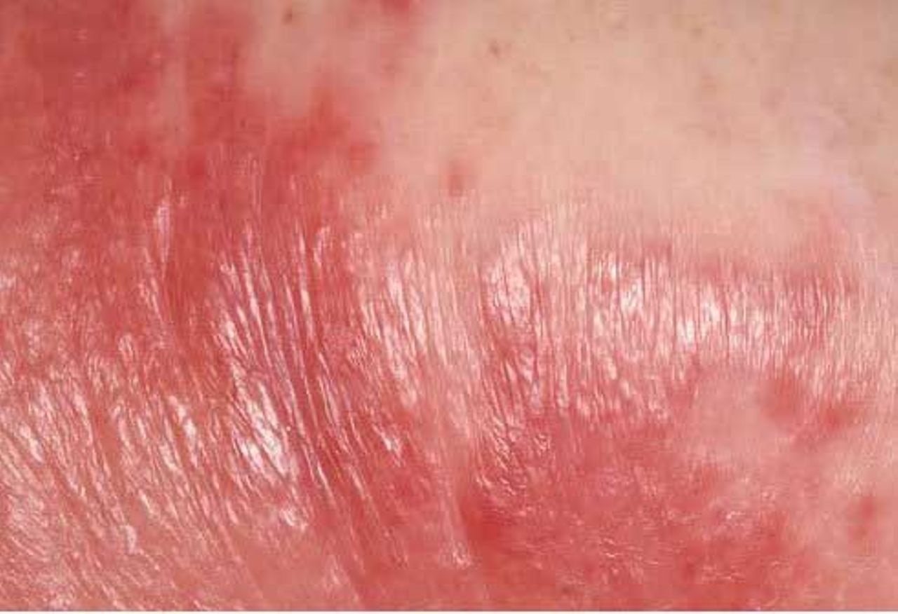 Cellulitis - Las Vegas Skin & Cancer Clinics