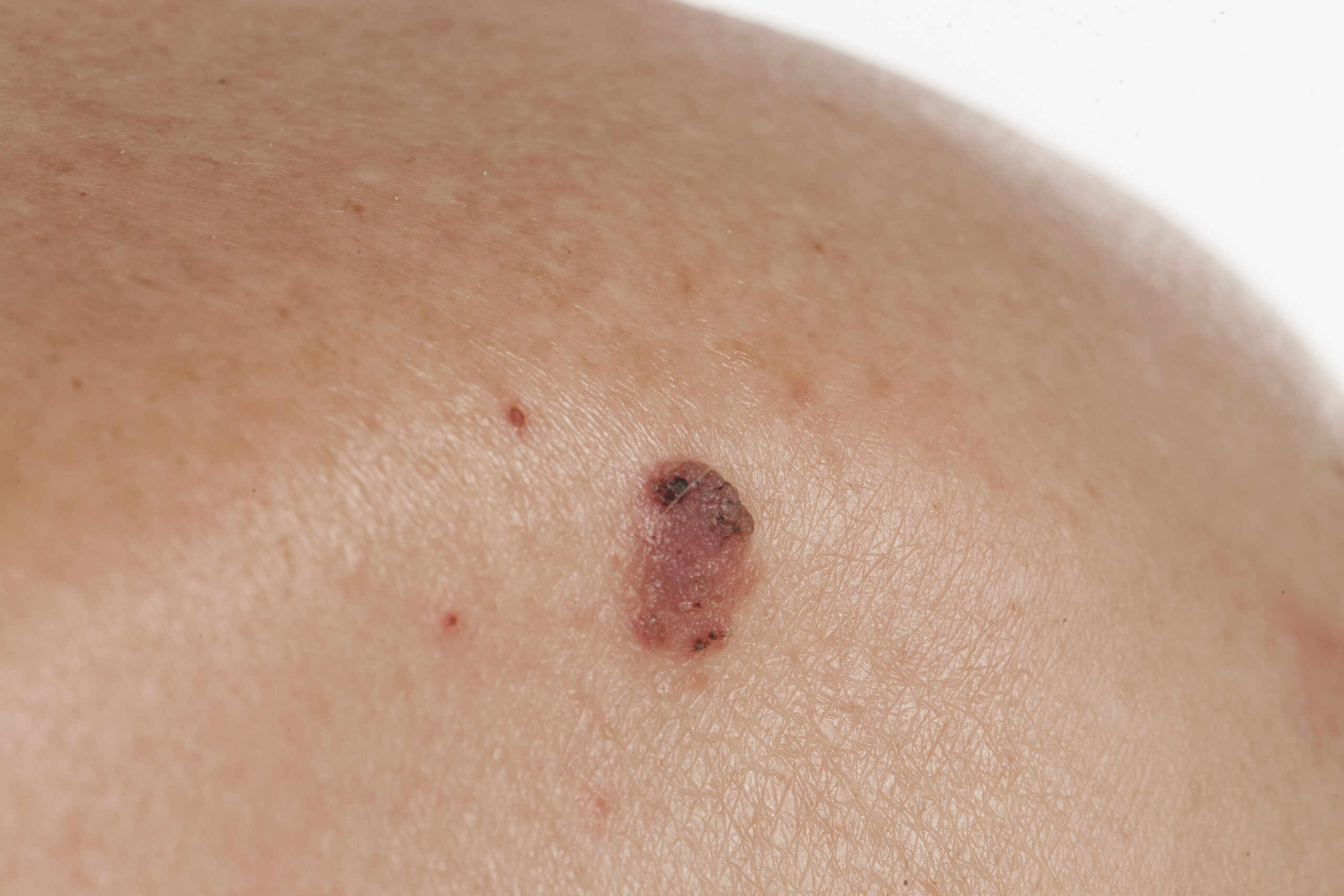 Skin Cancer Removal