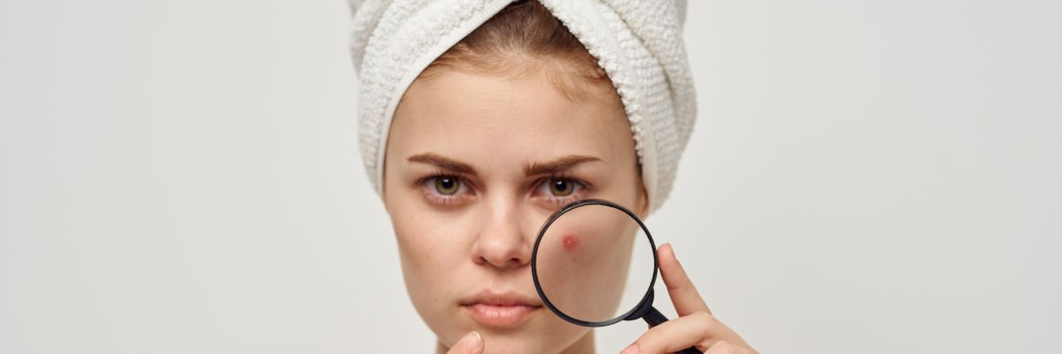 Let’s “Clear Up” Some Acne Myths - Las Vegas Skin & Cancer Clinics